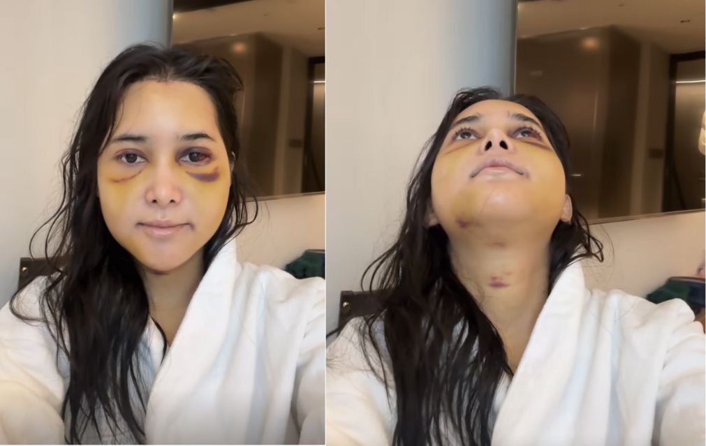 TikToker Dilan Janiyar dan Perjalanannya Jalani Operasi Plastik ...